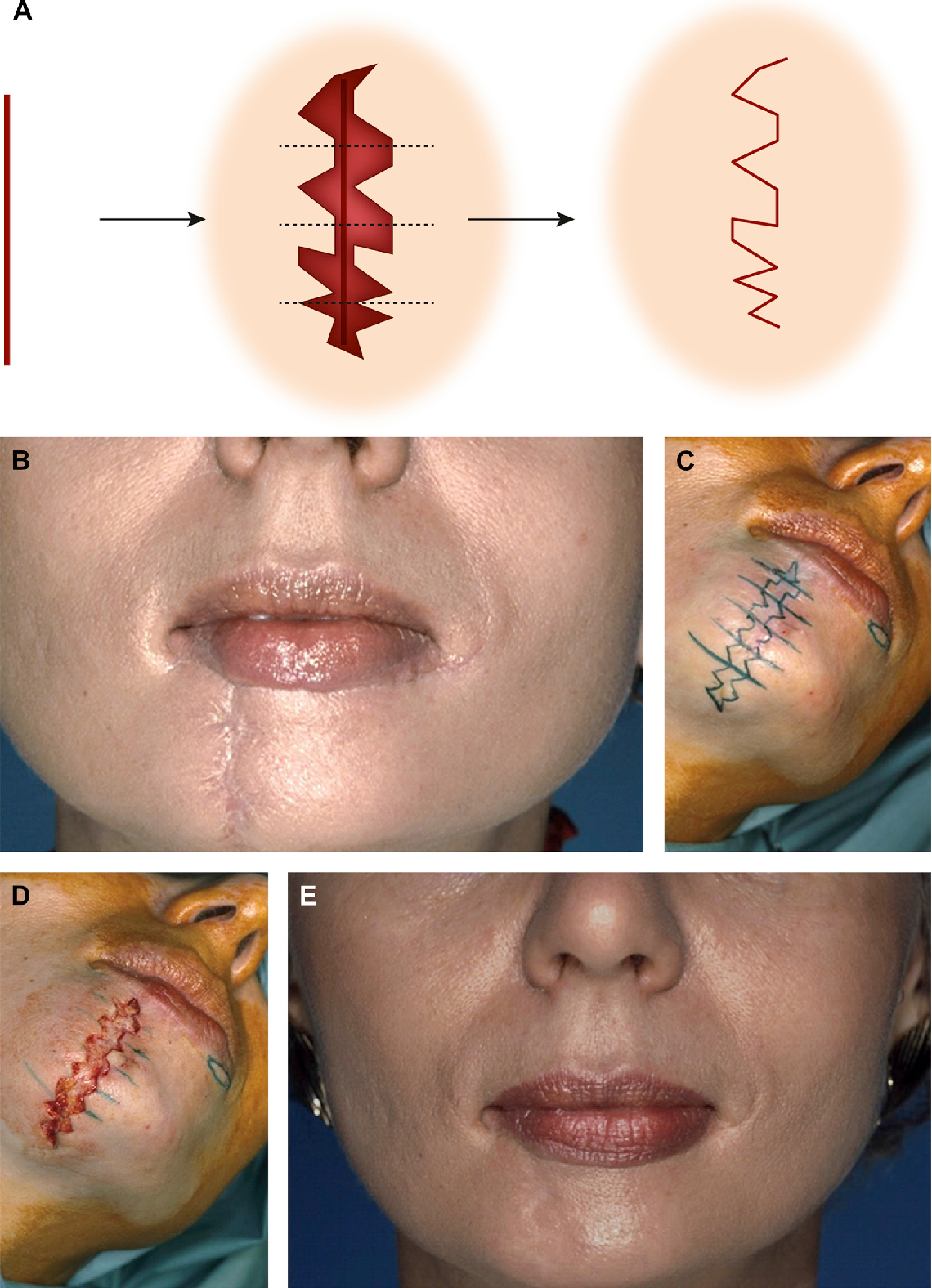 Figure 6 From Scar Revision And Recontouring Post Mohs Surgery