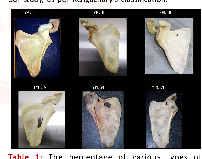 Figure 1 From Morphology Of Suprascapular Notch And Its Clinical