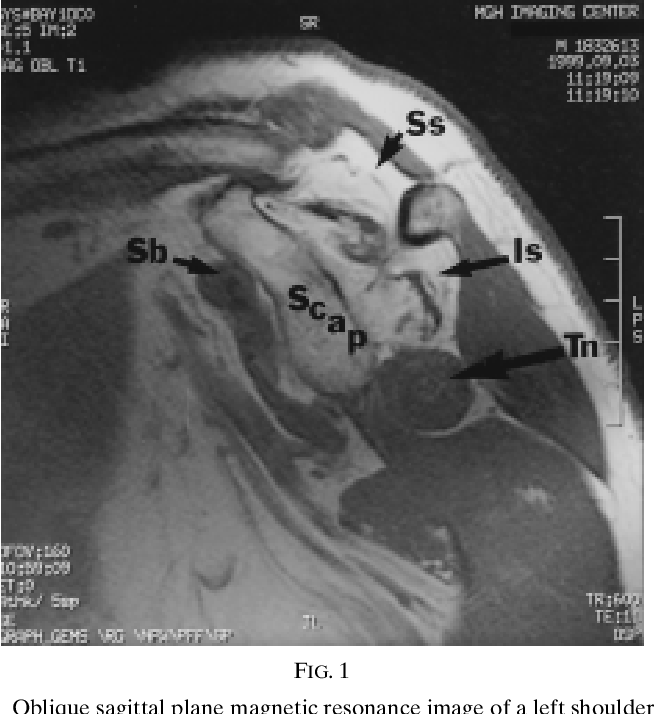 Figure 1 From Management Of Massive Irreparable Rotator Cuff Tears The