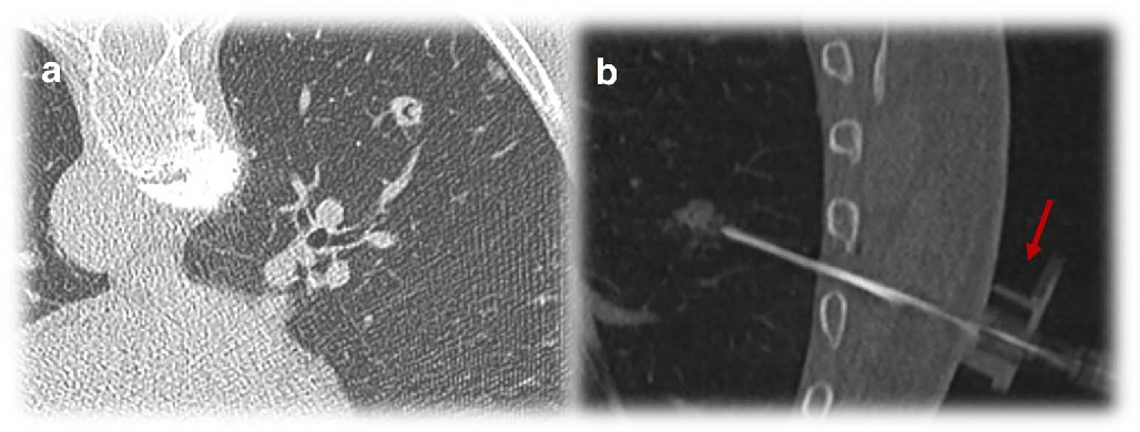 Figure 1 From Percutaneous Low Dose Ct Guided Lung Biopsy With An