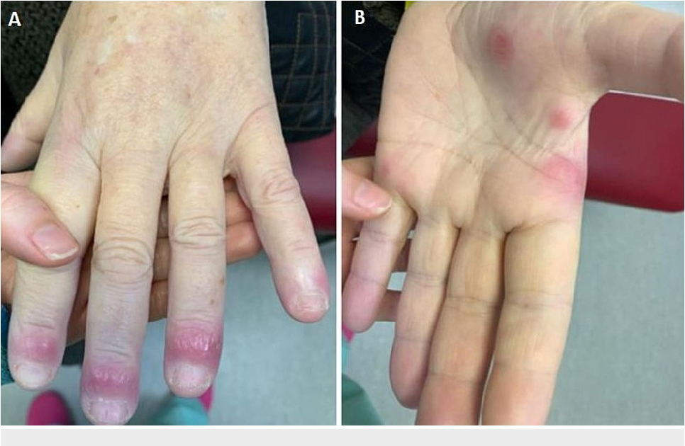 Figure 1 From Sweets Syndrome A Case Report Of A Rare Extraintestinal