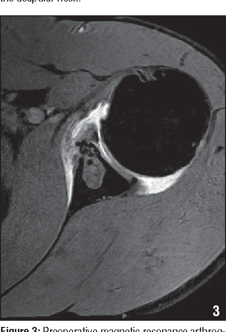 Intraosseous Ganglion With Impending Fracture Of The Glenoid