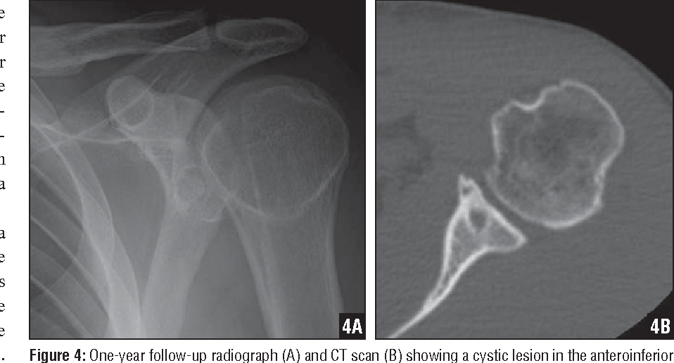 Figure 4 From Intraosseous Ganglion With Impending Fracture Of The