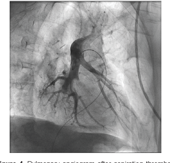 Figure 1 From Massive Pulmonary Embolism With St Elevation In Leads V