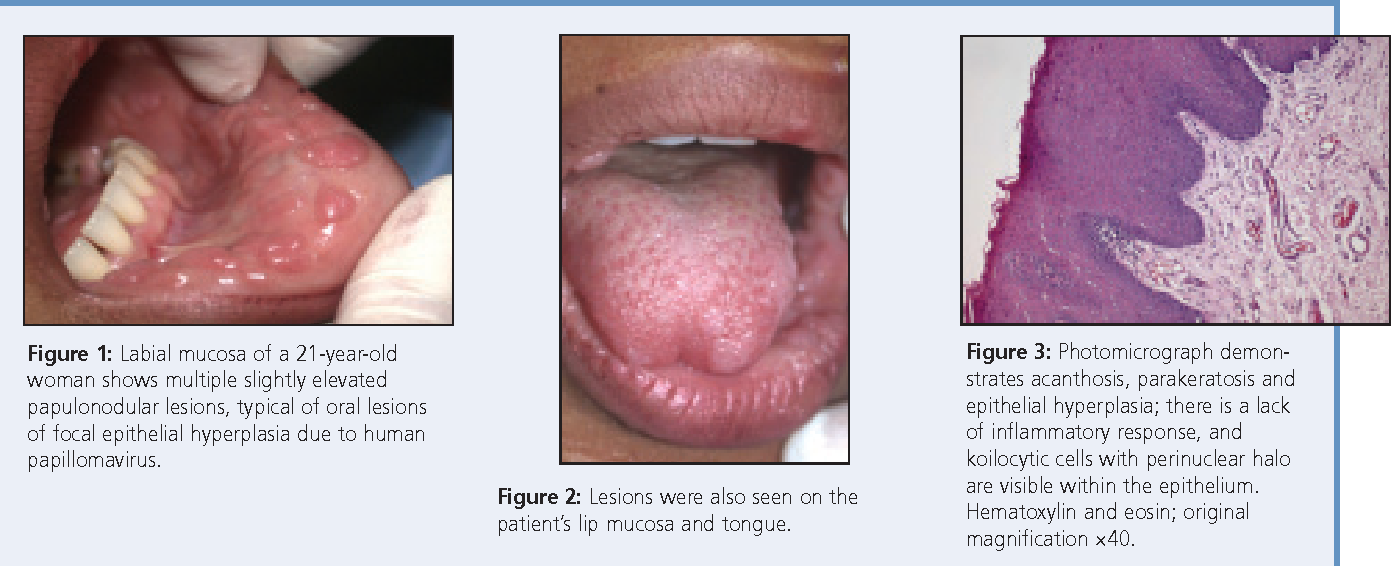 Focal Epithelial Hyperplasia