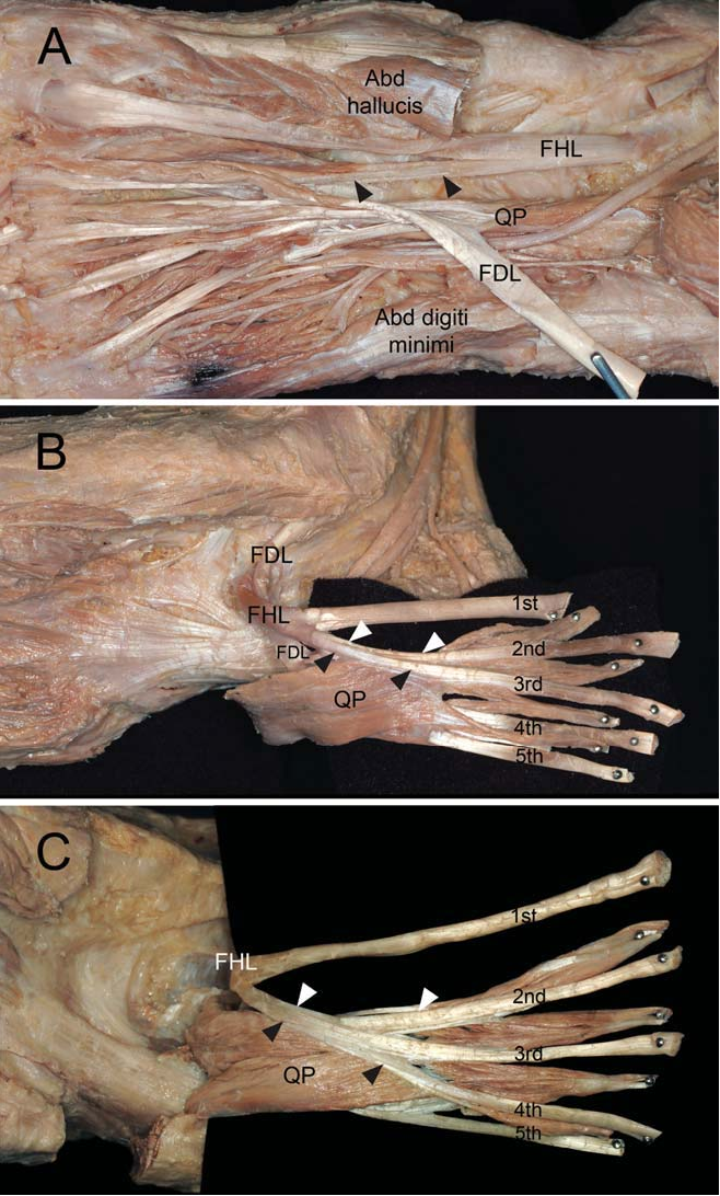 An Anatomic Study Of The Quadratus Plantae In Relation To Tendinous