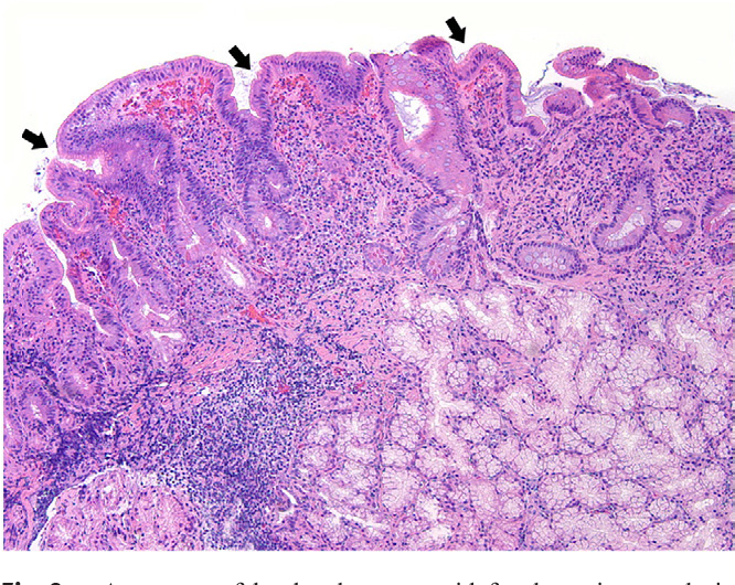 Gastric Metaplasia Semantic Scholar