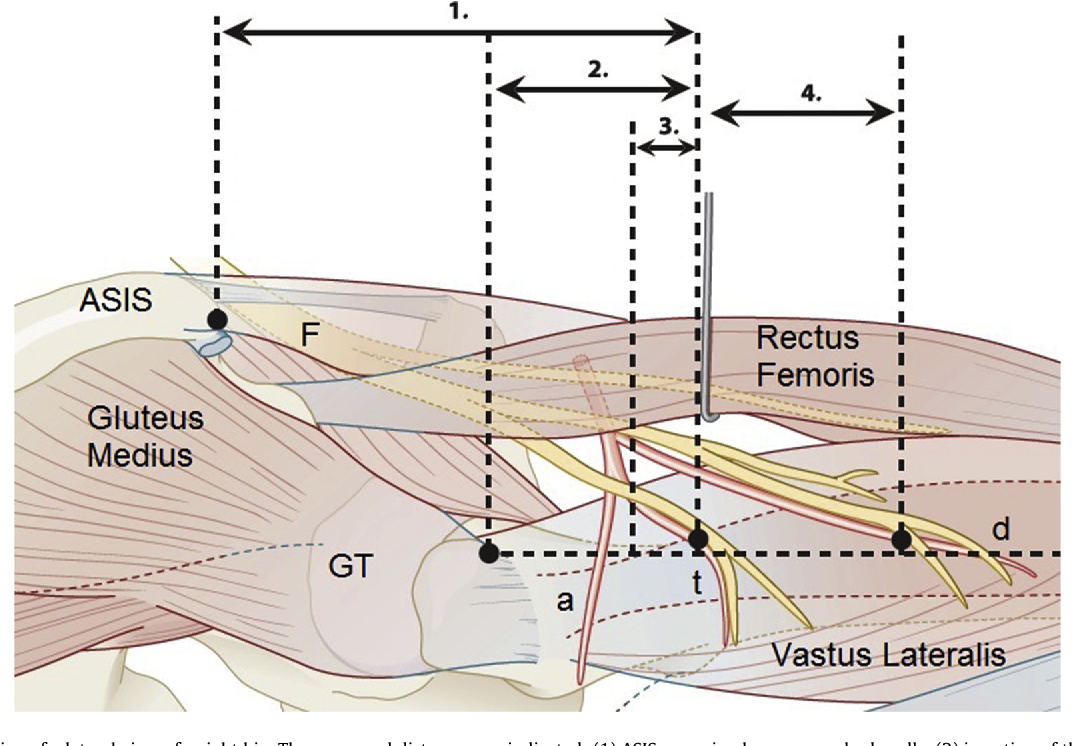 Direct Anterior Approach Direct Anterior Approach Tec