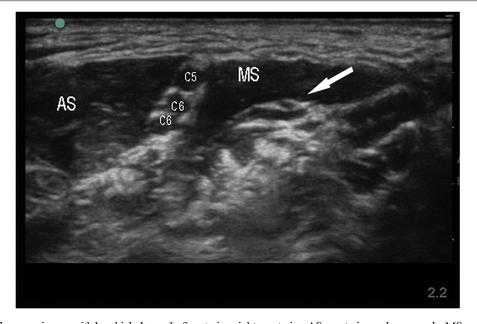 Scapula Ultrasound