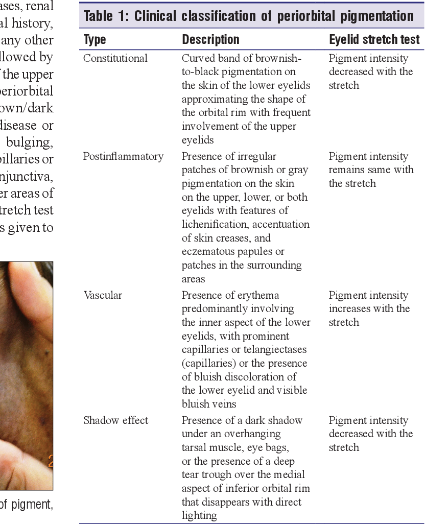 Figure 1 From Clinical And Dermoscopic Evaluation Of Periorbital