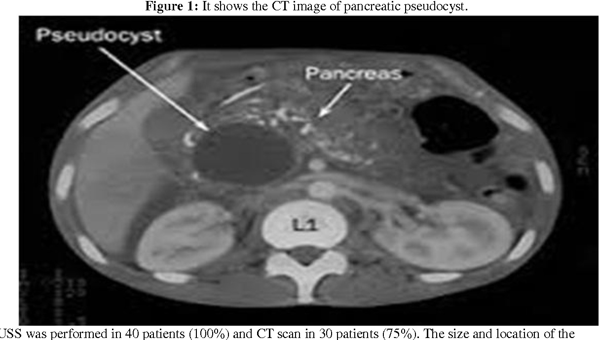 Pseudocyst Of Pancreas