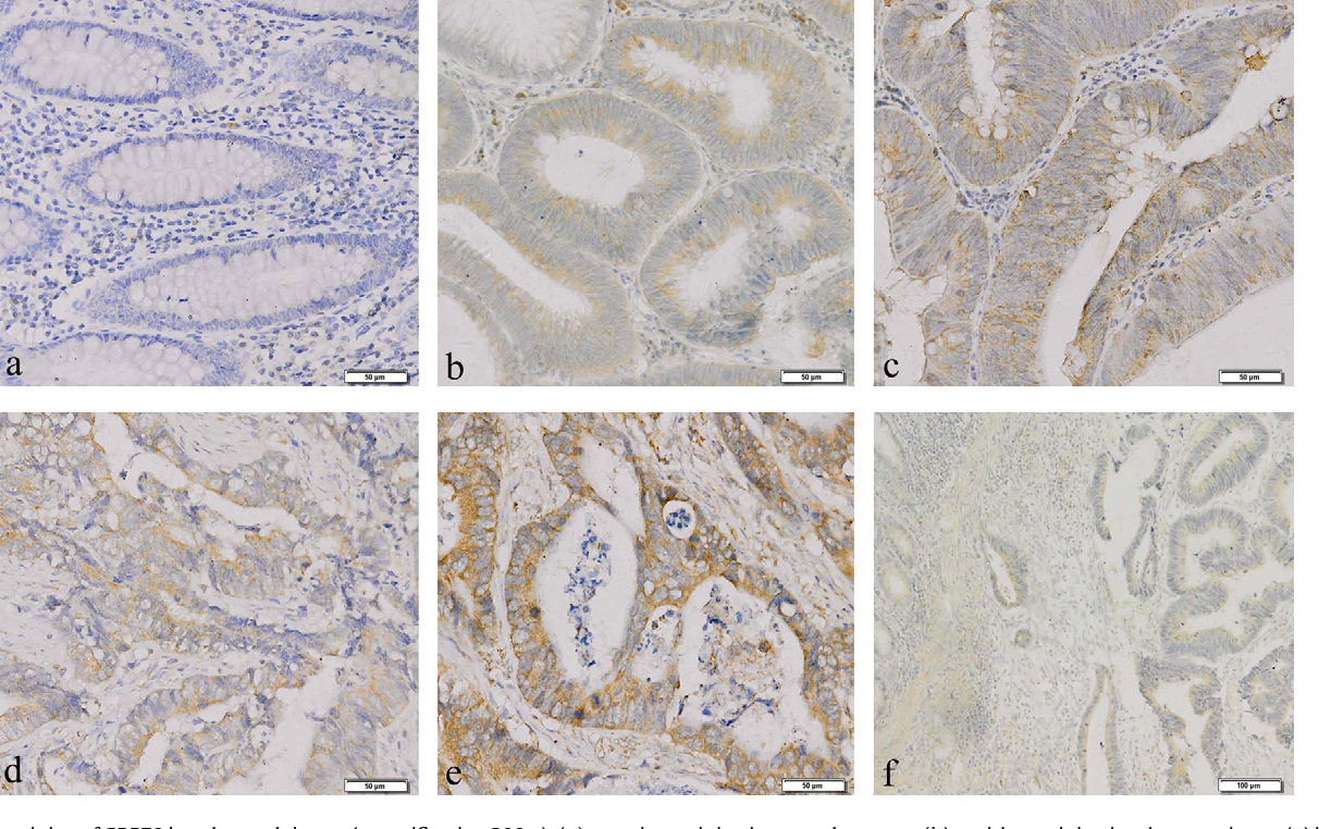 Figure 1 From Glucose Regulated Protein 78 Grp78 Is Overexpressed In