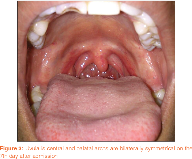 Isolated Palatal Palsy A Clinical Rarity Semantic Scholar