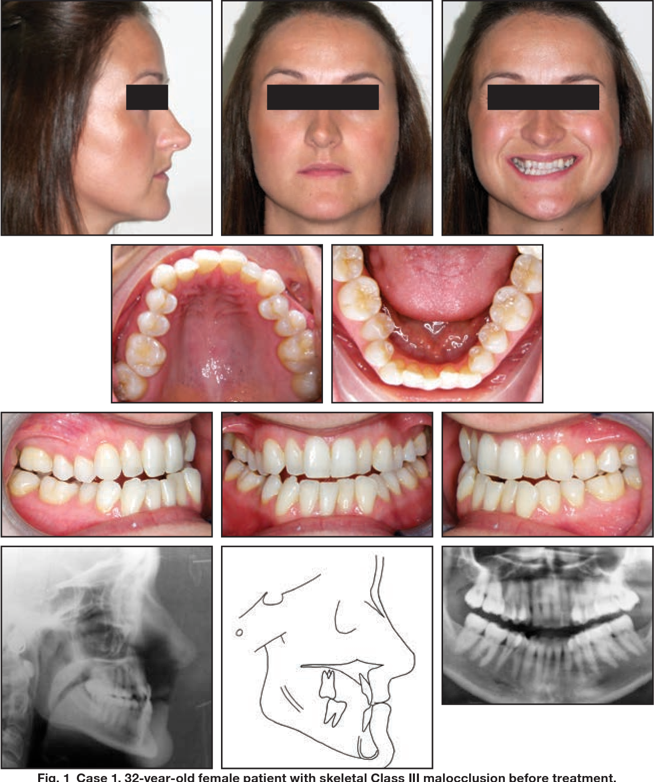 Figure 1 From Invisalign Treatment Of Class Iii Malocclusion With Lower