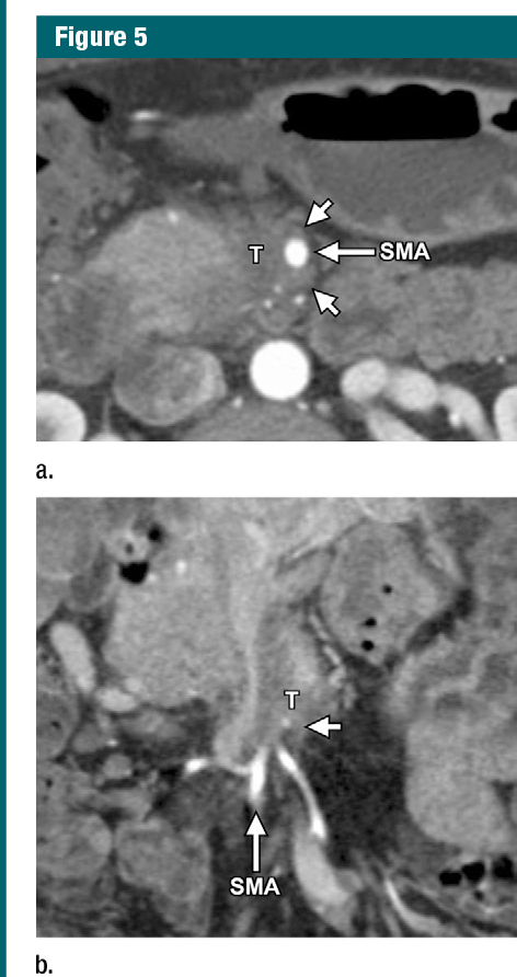 Figure 1 From Pancreatic Ductal Adenocarcinoma Radiology Reporting