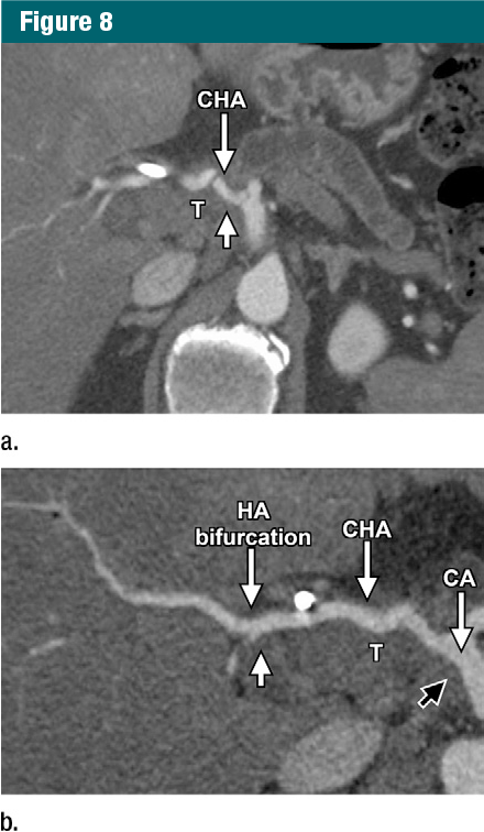 Figure 1 From Pancreatic Ductal Adenocarcinoma Radiology Reporting