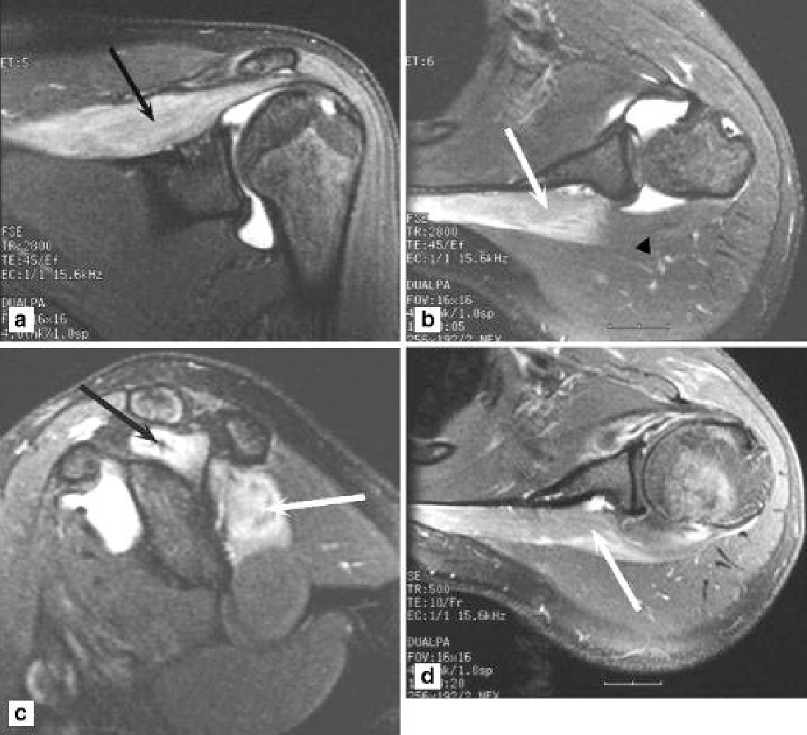 Figure 1 From Musculoskeletal Mr Imaging Evaluation Of Suprascapular