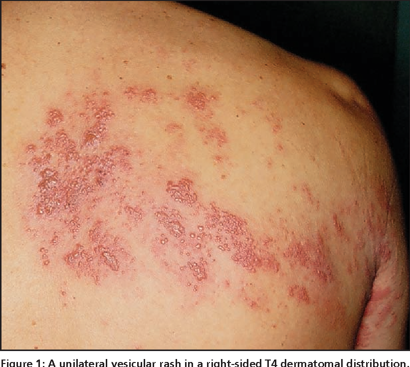 Figure 1 From A 69 Year Old Man With A Painful Vesicular Rash