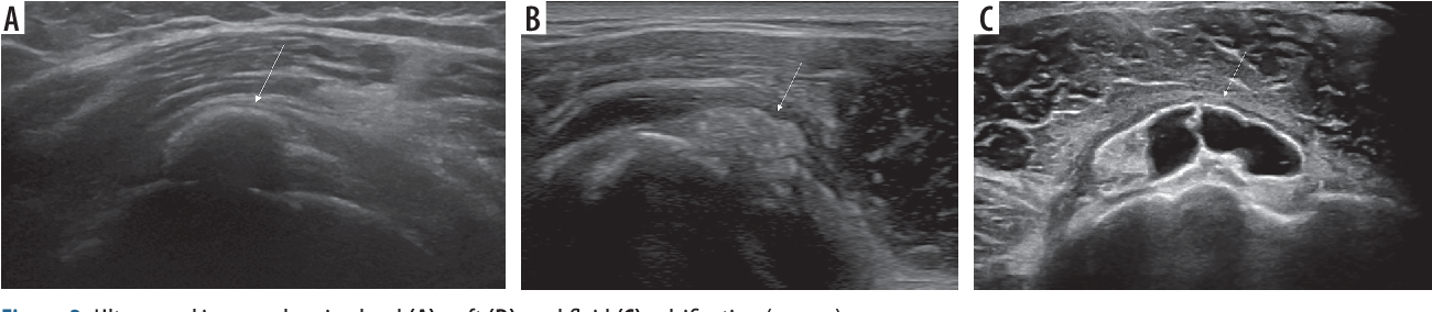 Figure 1 From Ultrasound Guided Percutaneous Irrigation Of Rotator Cuff