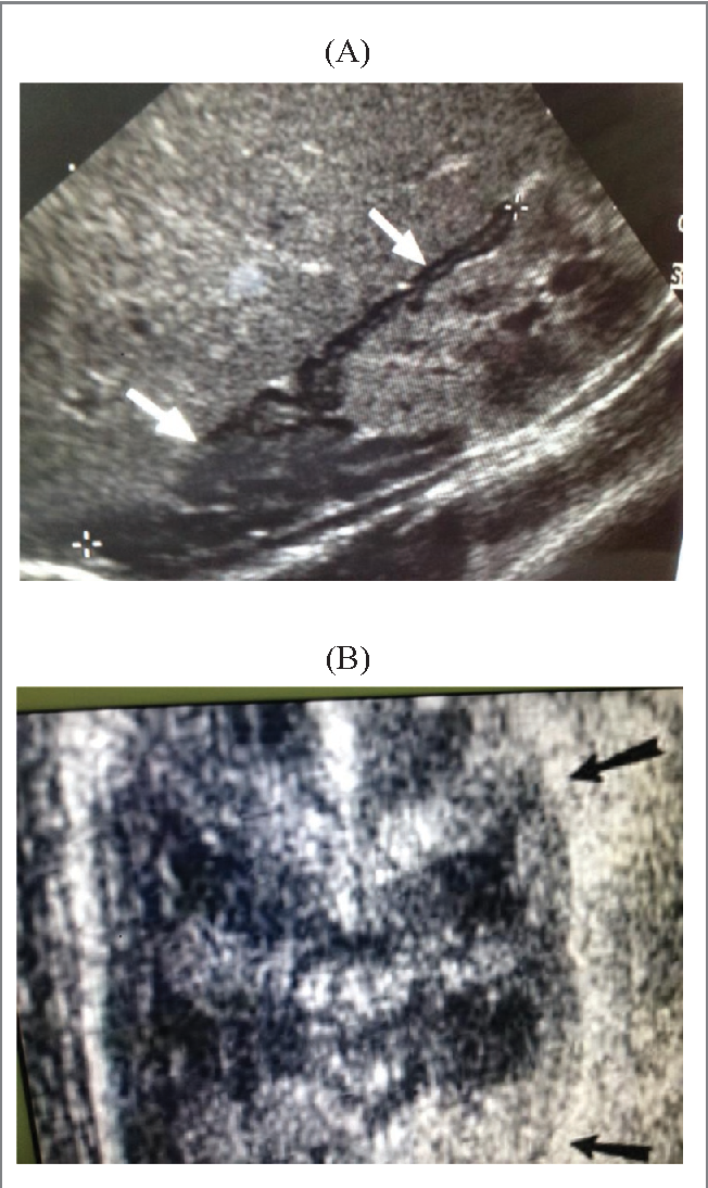 Figure 2 From Radiological Imaging Of Disorders Of Sex Development Dsd