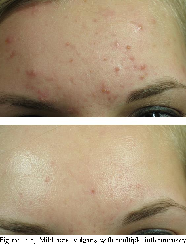 Transplantation Erwachsen Person Nd Yag Laser Acne Scars Stengel