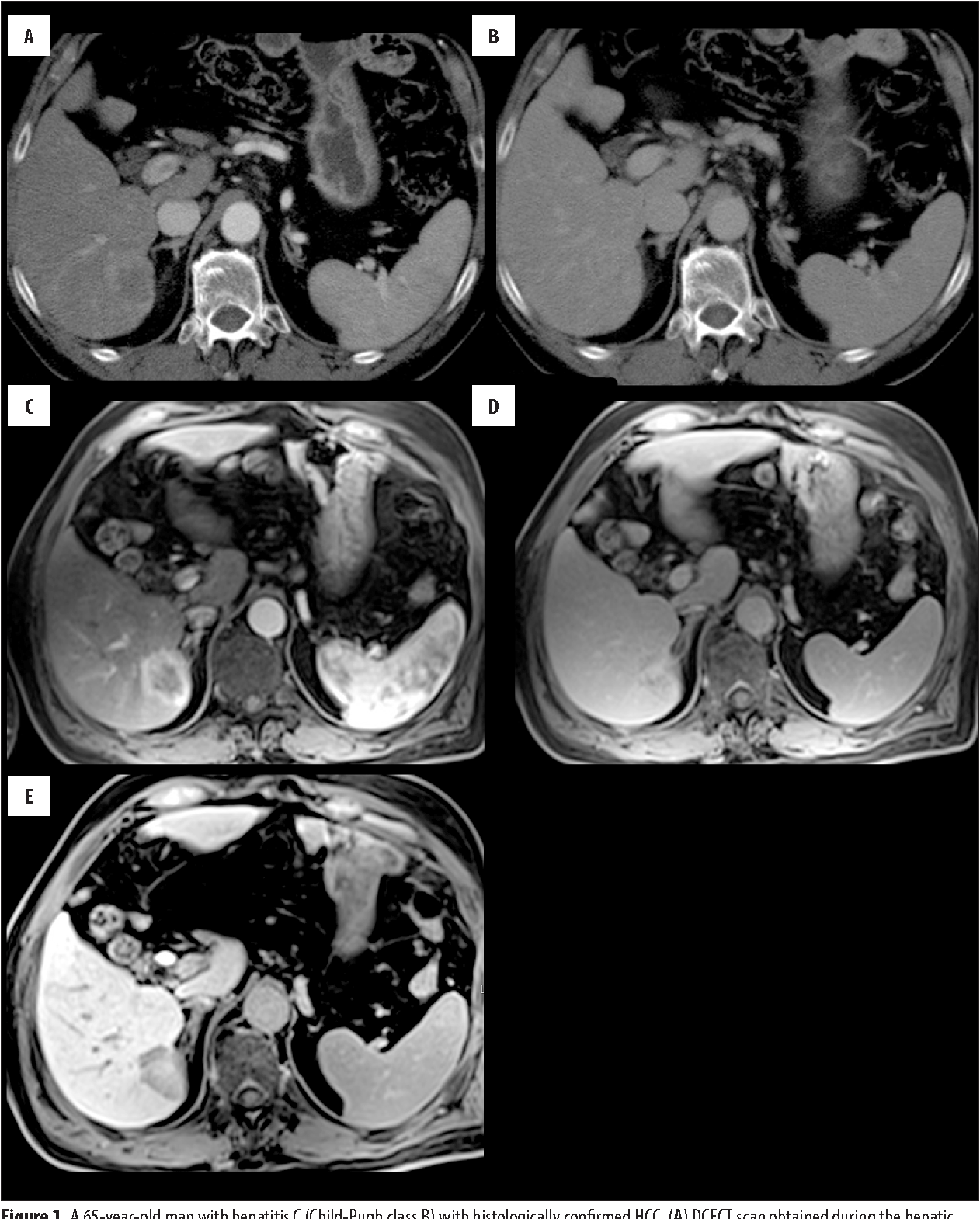 Diagnostic Accuracy Of Gd Eob Dtpa For Detection Hepatocellular