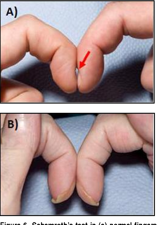 Pdf Examination For Finger Clubbing Semantic Scholar