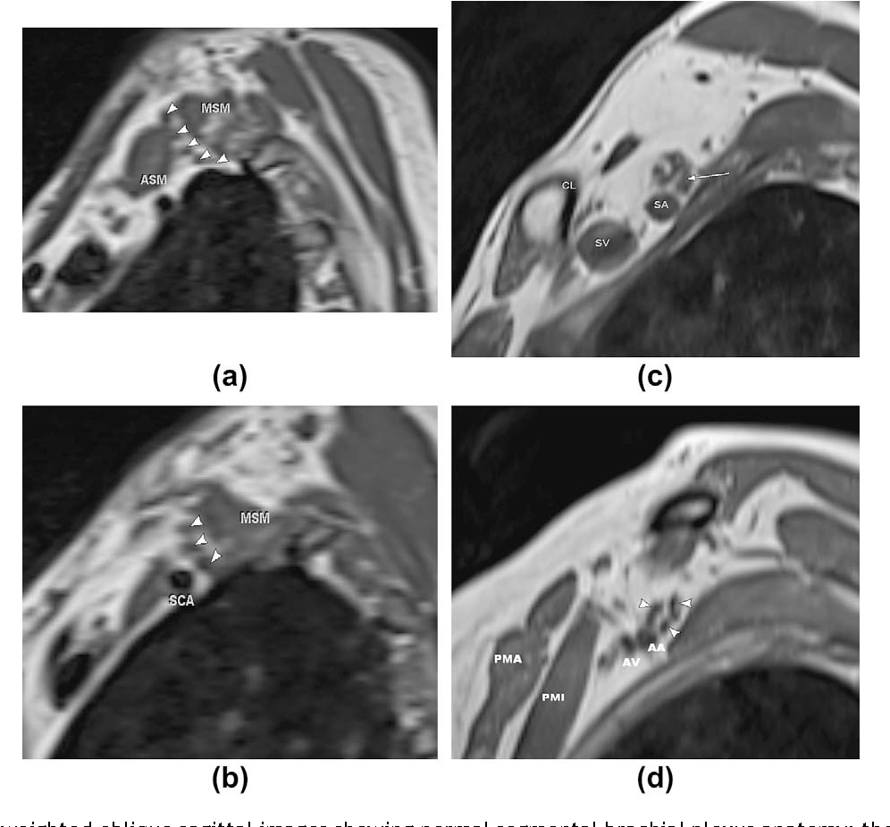 Figure 1 From Mri Of Brachial Plexopathies Semantic Scholar