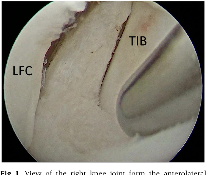 Arthroscopic Saucerization Of Discoid Lateral Meniscus With Meniscus