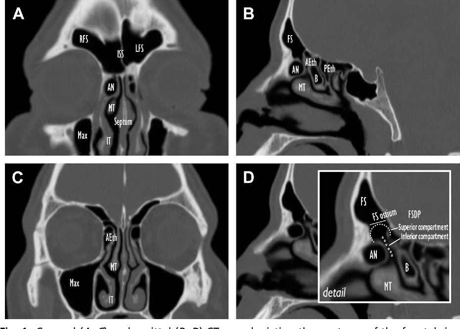 Figure 3 From Overview Of Frontal Sinus Pathology And Management