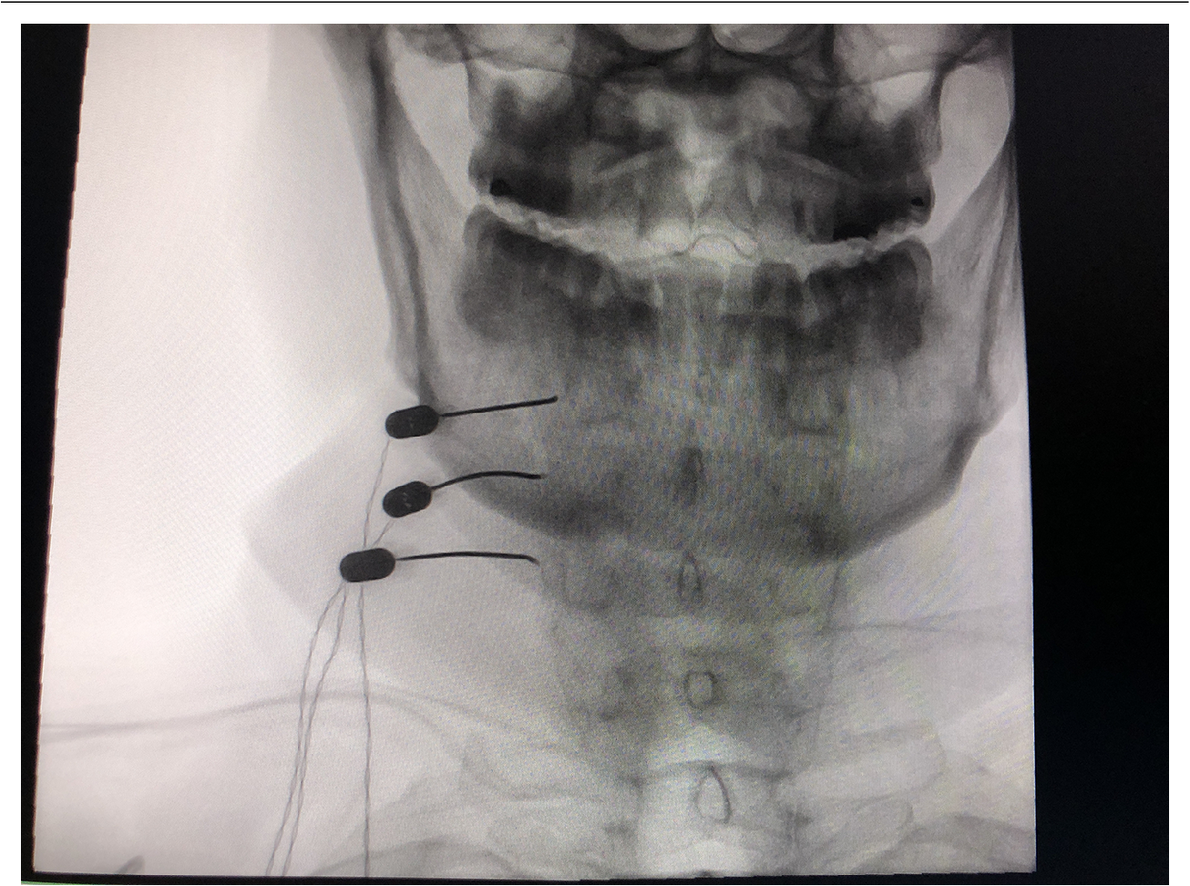 Pdf Combined Continuous Radiofrequency Ablation And Pulsed