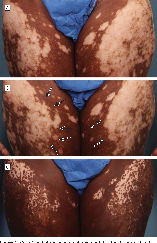 Figure 1 From The Efficacy Of Afamelanotide And Narrowband Uv B