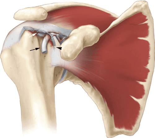 Figure 6 From Mri Of Impingement Syndromes Of The Shoulder Semantic