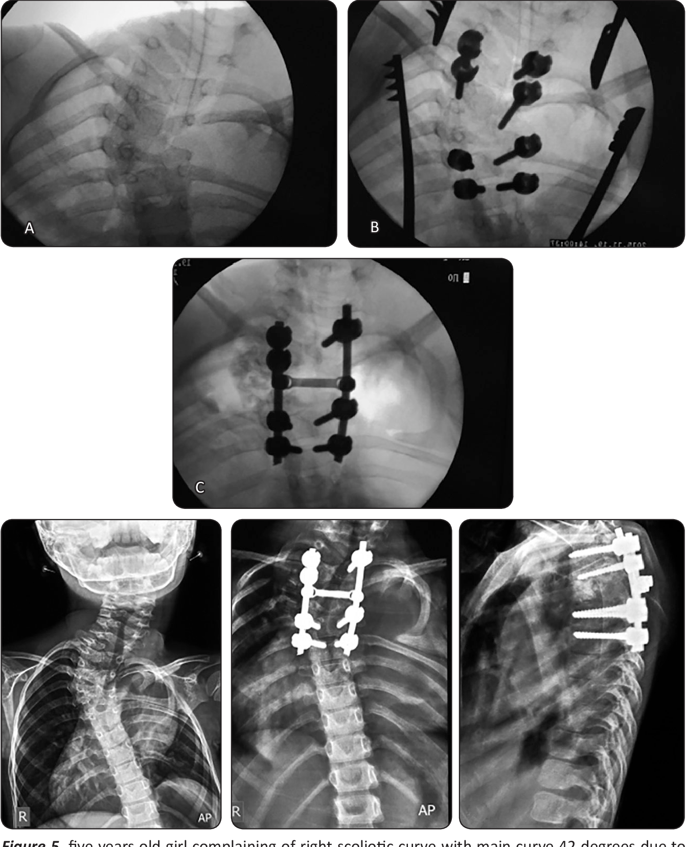 Figure 1 From Single Stage Posterior Hemivertebra Resection With