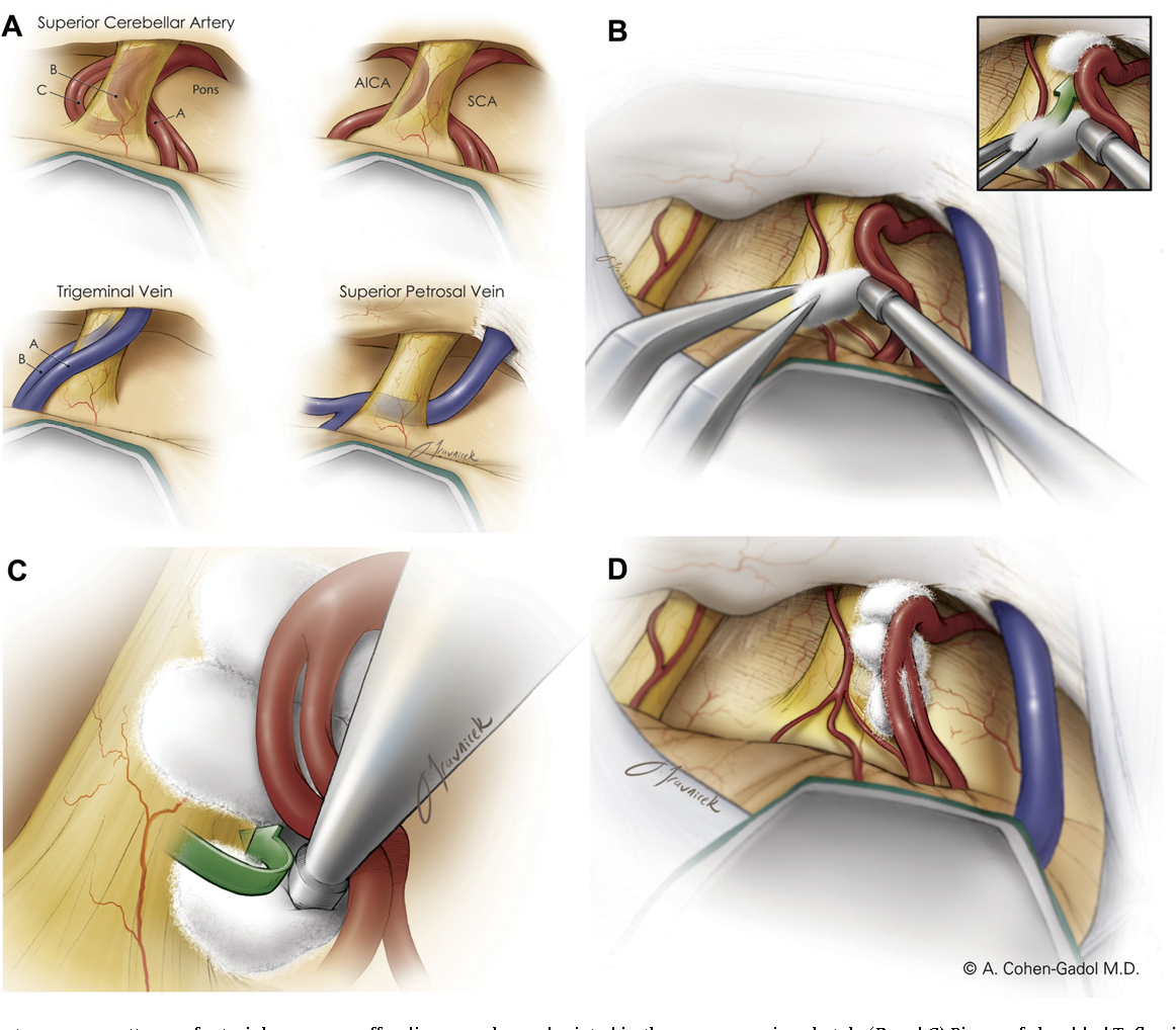 Figure 4 From Clinical Neurology And Neurosurgery Microvascular