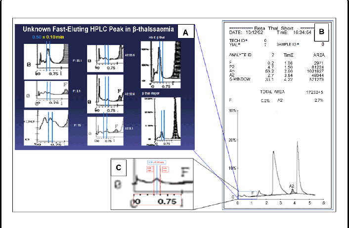 Figure 1 From Reasons Of Unknown Hplc Peaks During Hemoglobin Analysis