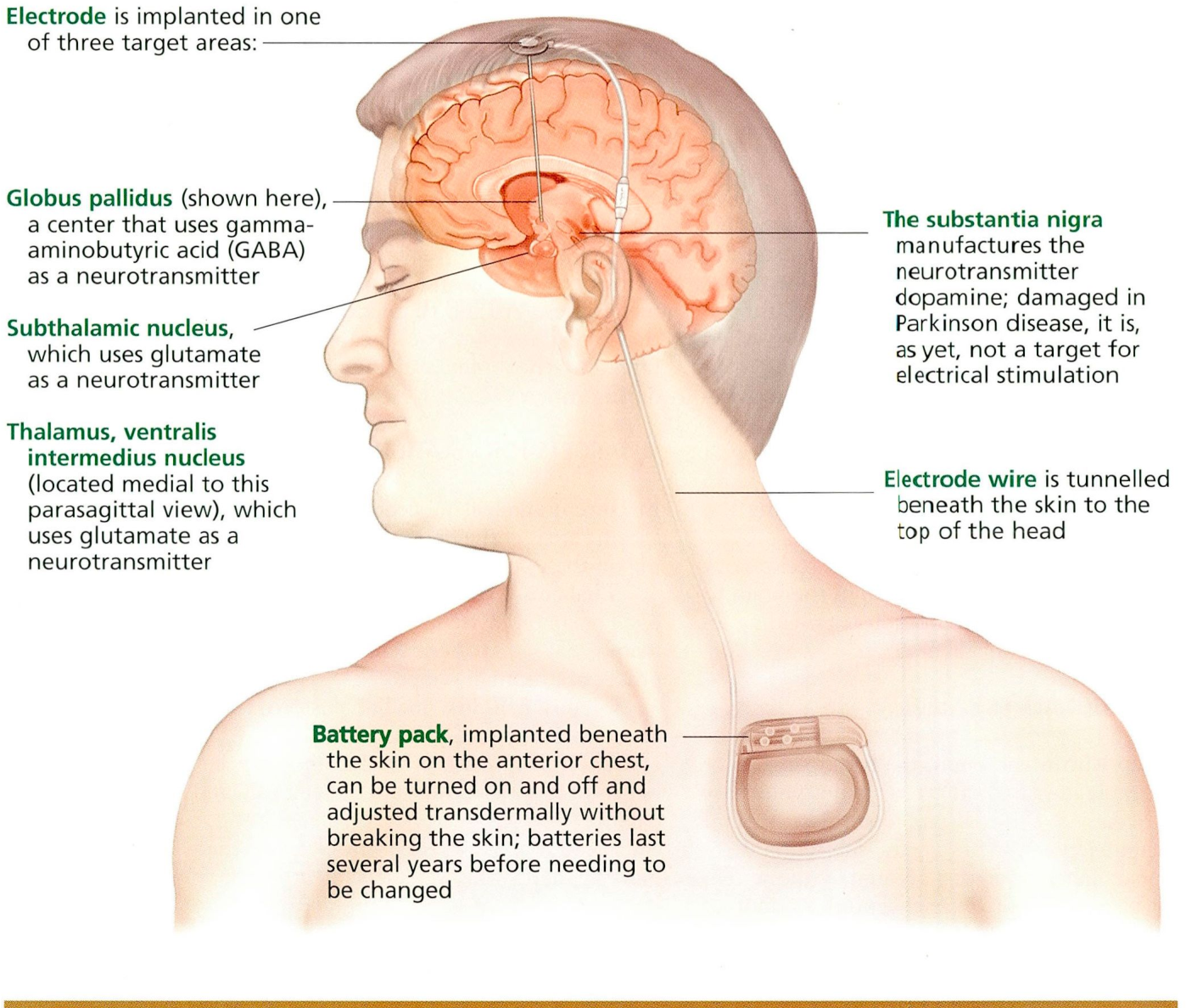 Figure 1 From Deep Brain Stimulation Reduces Symptoms Of Parkinson