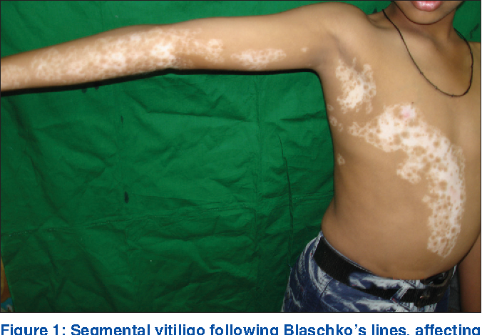 Table 1 From A Descriptive Study To Characterize Segmental Vitiligo