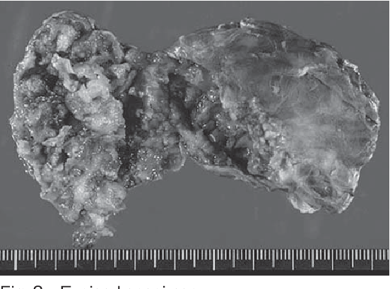 A Case Of Pelvic Retroperitoneal Neurilemmoma Developing From The