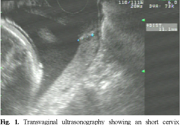 Placental Abruption Ultrasound Diagnosis