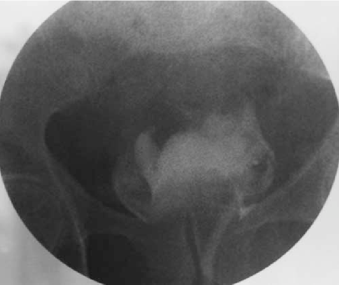 Figure 1 From Bladder Explosion During Transurethral Resection Of The