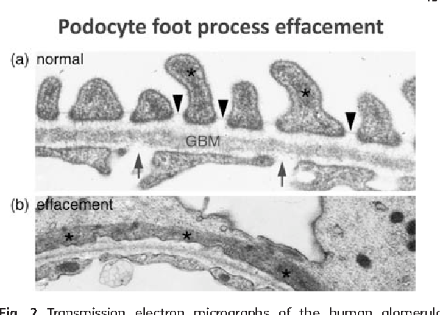 Figure 2 From The Podocyte Cytoskeleton In Health And In Disease