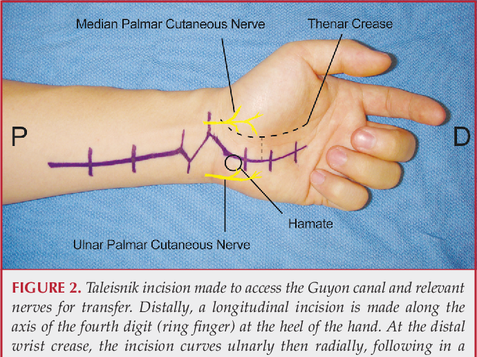 Distal Median To Ulnar Nerve Transfers To Restore Ulnar Motor And My