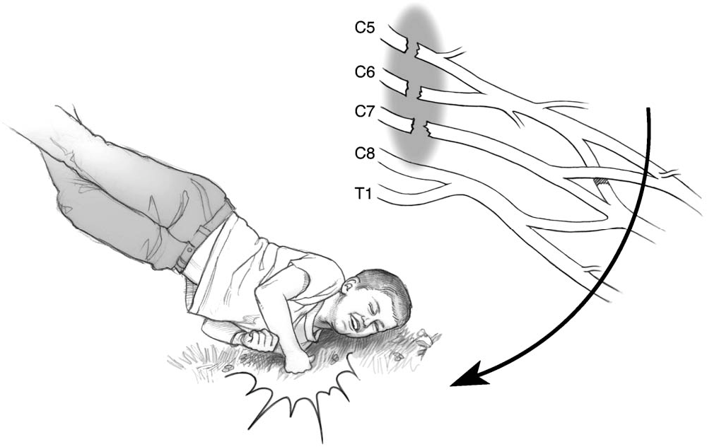 Brachial Plexus Injury Pdf Doctorvisit