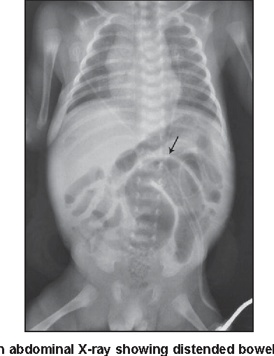 Figure 1 From Sigmoid Volvulus In A Neonate Case Report And Review Of