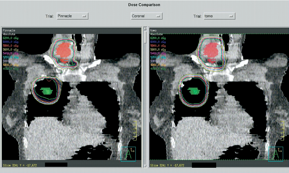 Table 1 From Comparison Of Imrt Treatment Plans Between Linac And