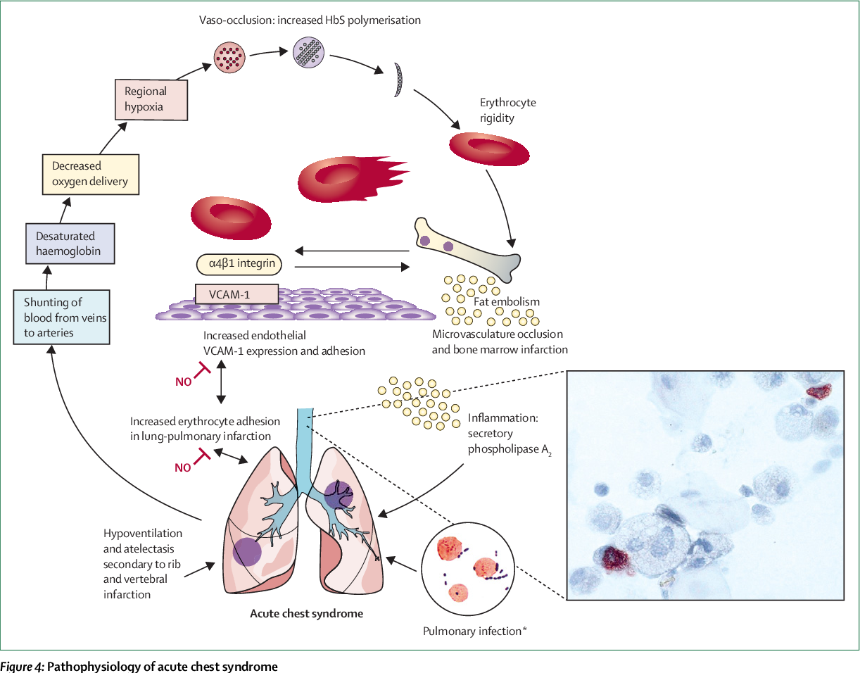 Pdf Sickle Cell Disease Semantic Scholar