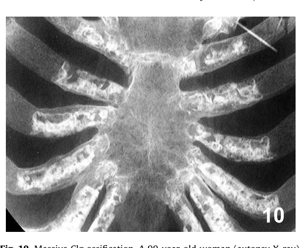 Figure 9 From Sexual Dimorphism Of Ossified Costal Cartilage