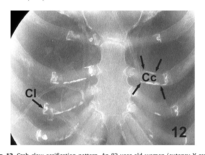 Figure 9 From Sexual Dimorphism Of Ossified Costal Cartilage