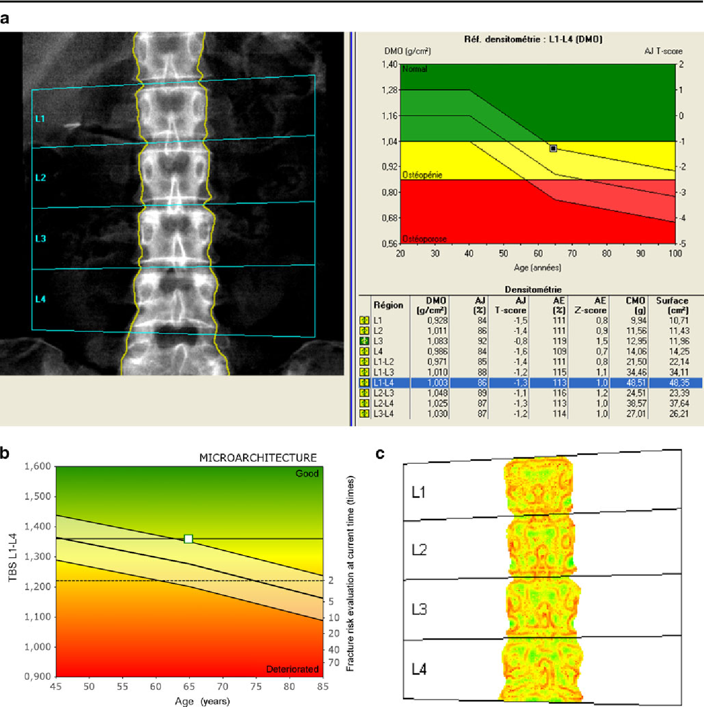 Trabecular Bone Score Tbs Available Knowledge Clinical Relevance